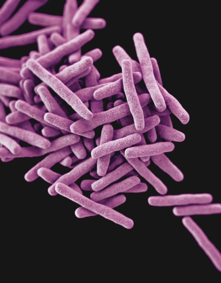 Tuberculosis outbreak: What you need to know