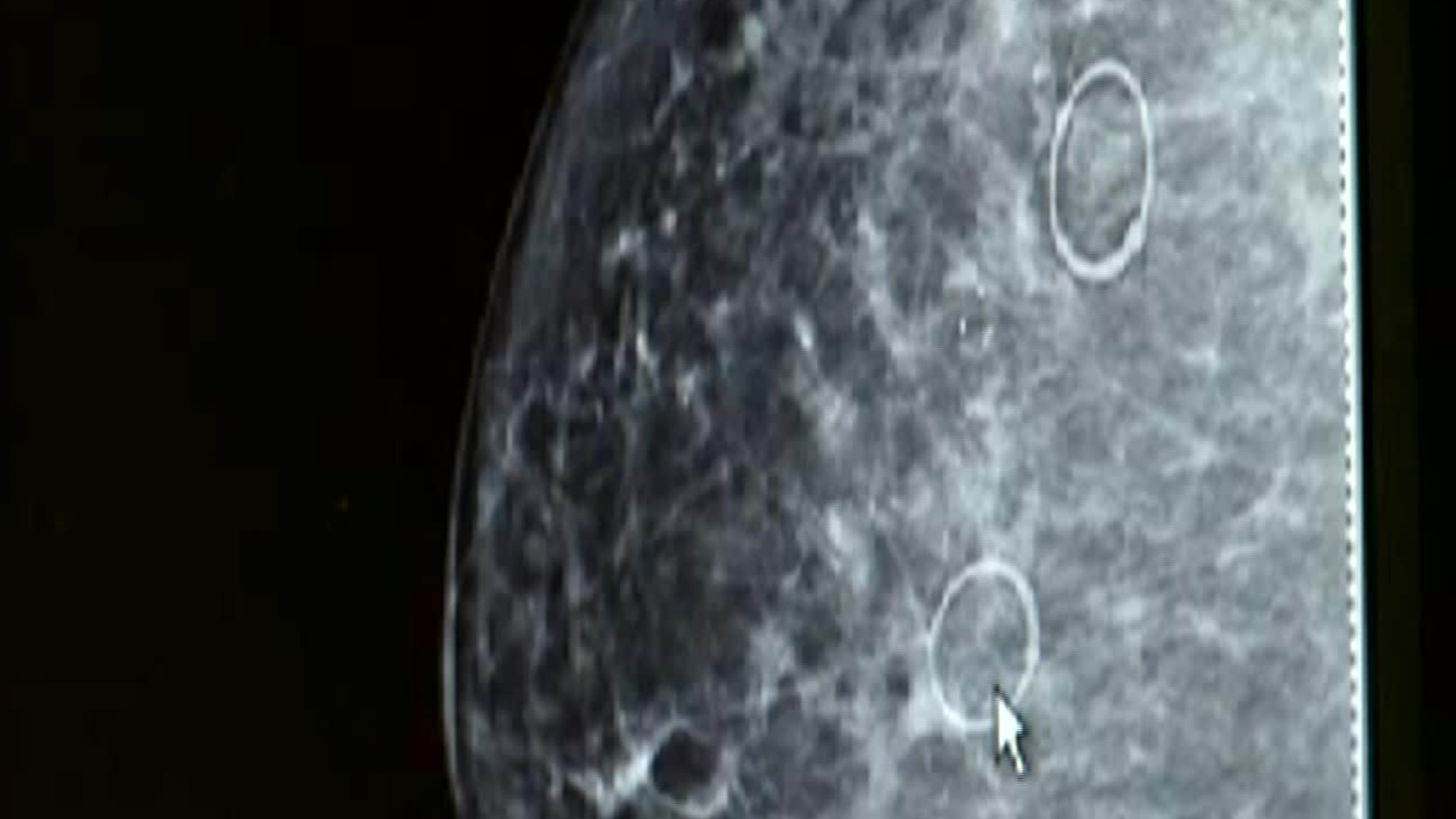 Un essai de dépistage du cancer du sein basé sur l'IA pourrait ...