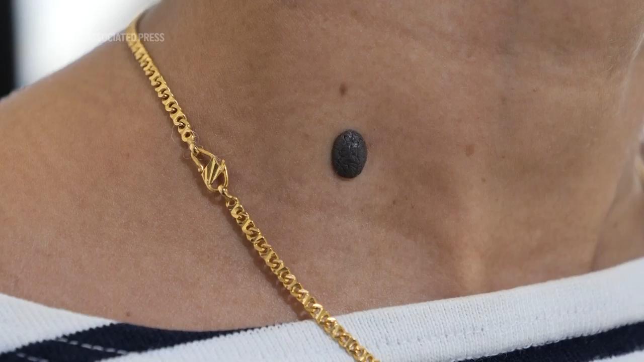 AI skin cancer detection app claims 99.8 per cent accuracy rate in ...