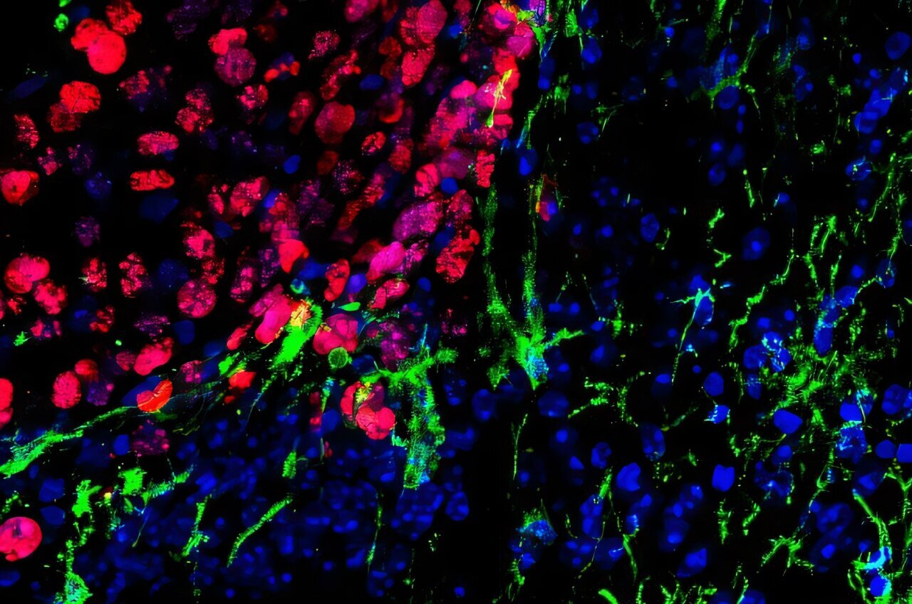 Microglia reprogramming offers novel strategy to combat melanoma brain ...