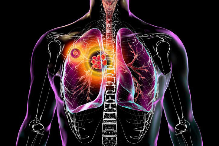 Tuberculosis: What You Need to Know About the Recent Outbreak, Risk ...