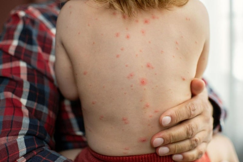 Résurgence de la Rougeole : entre causes et riposte