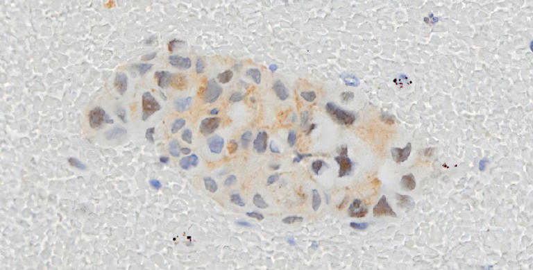 Weakness in lung cancer's defenses found—an enzyme that boosts cancer ...