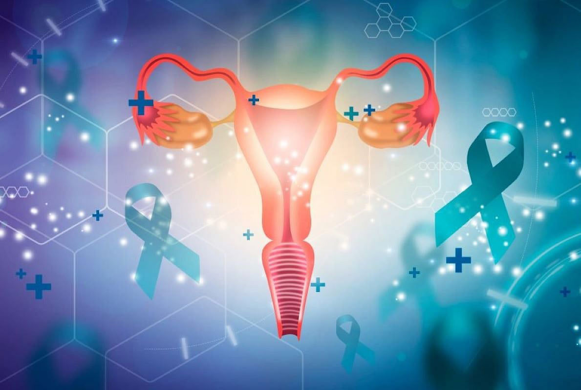 Study Identifies Some Modifiable Risk Factors for Ovarian Cancer Study Identifies Some Modifiable Risk Factors for Ovarian Cancer