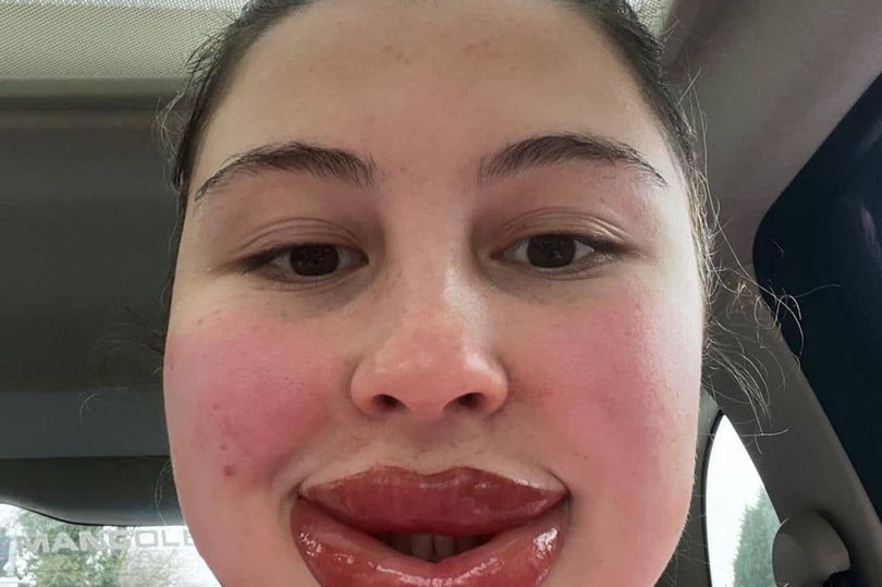 Woman left with pout like Monsters Inc character after bid for perfect lips