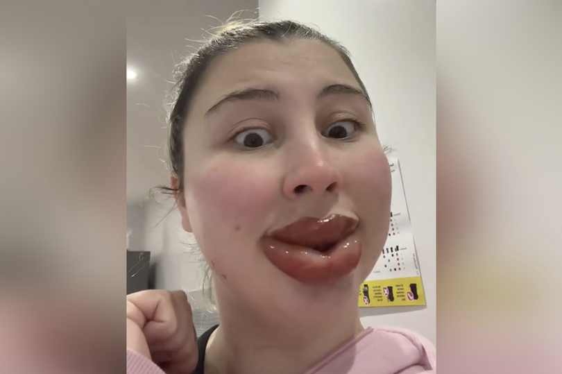 Woman who had 'extreme trout pout reaction' to lip procedure explains ...