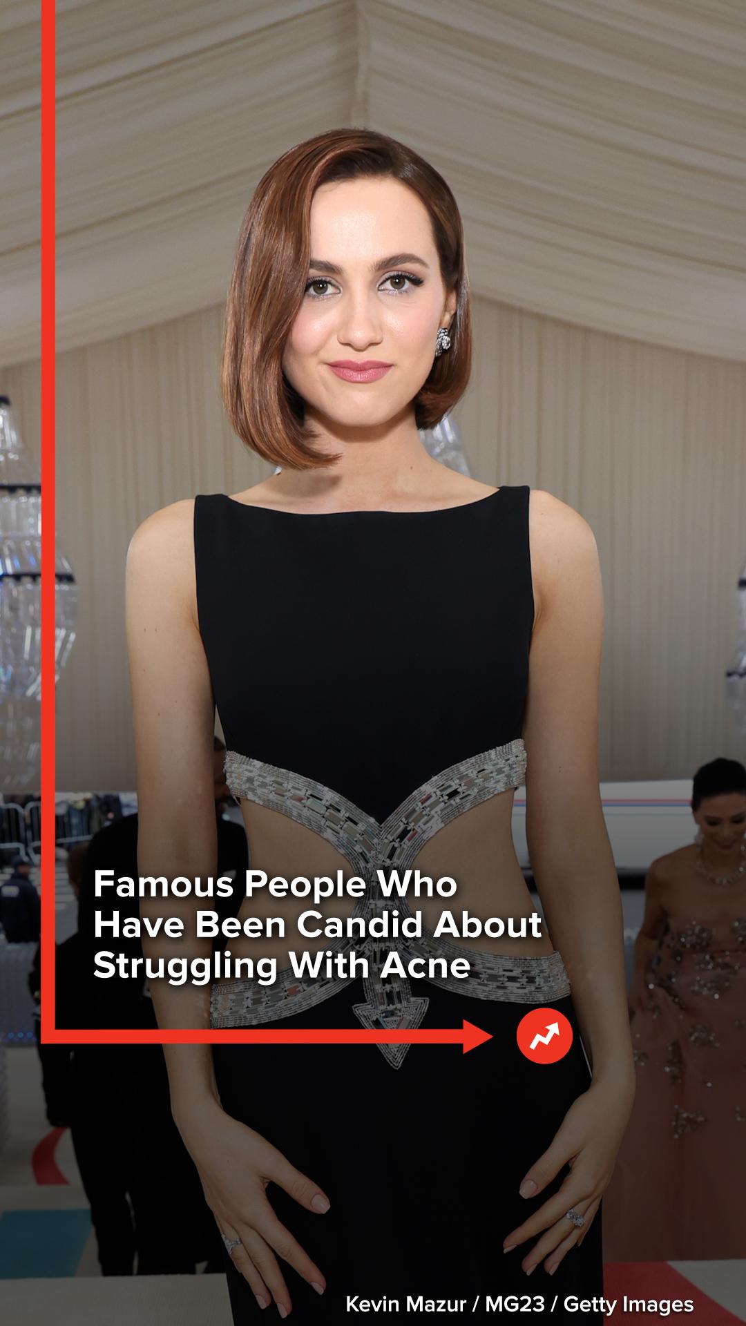 Famous People Who Have Been Candid About Struggling With Acne