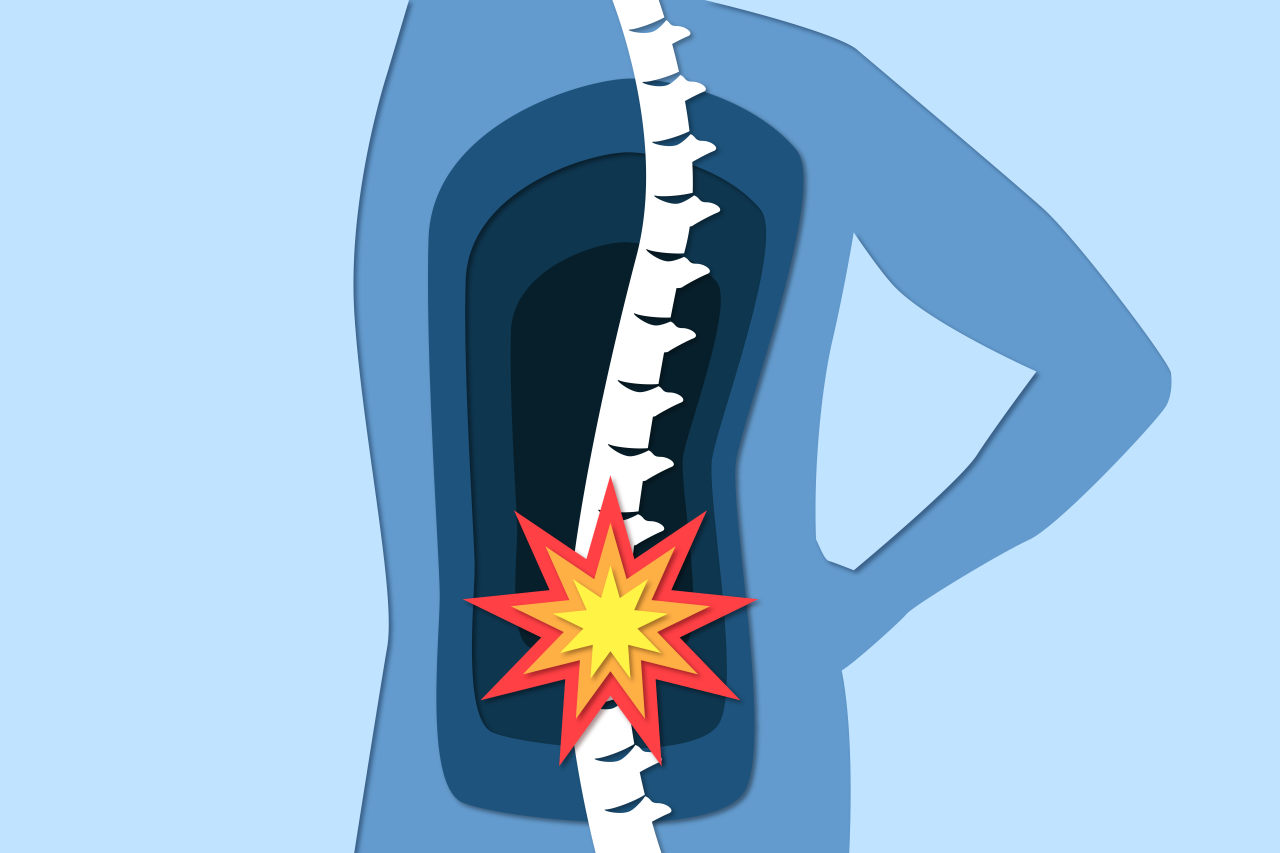 Spinal Fusion to Ease Severe Back Pain Is Tried and True. Now There’s ...