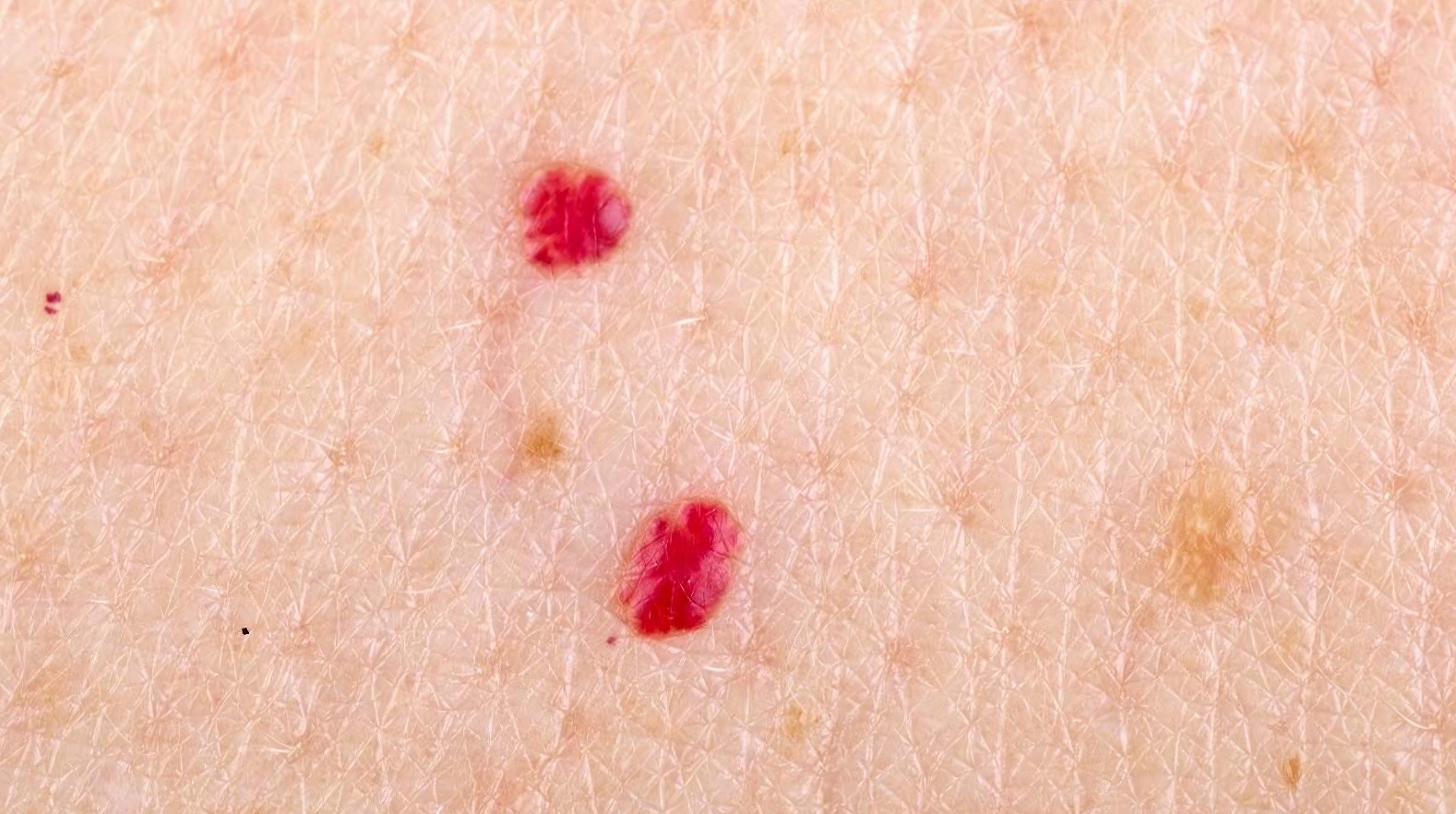 La raison pour laquelle vous avez des points rouges sur votre peau