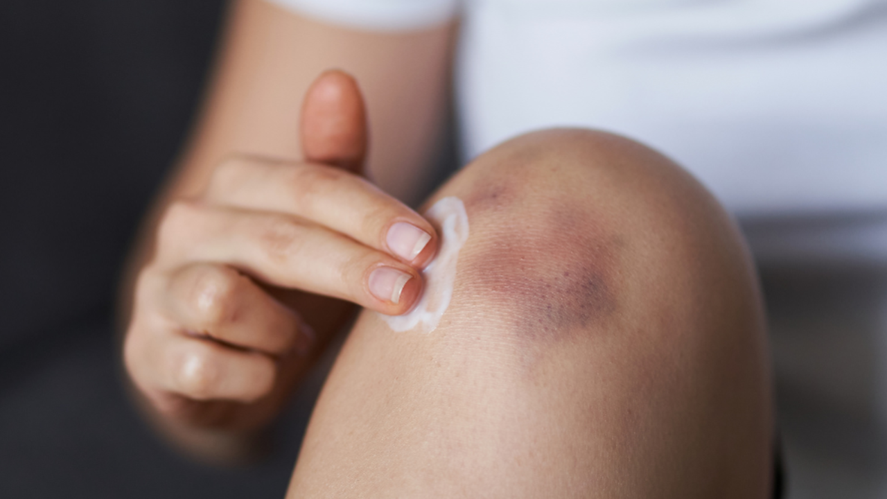 Random Bruising After Workout? Your Body Has 1 Of These 5 Things