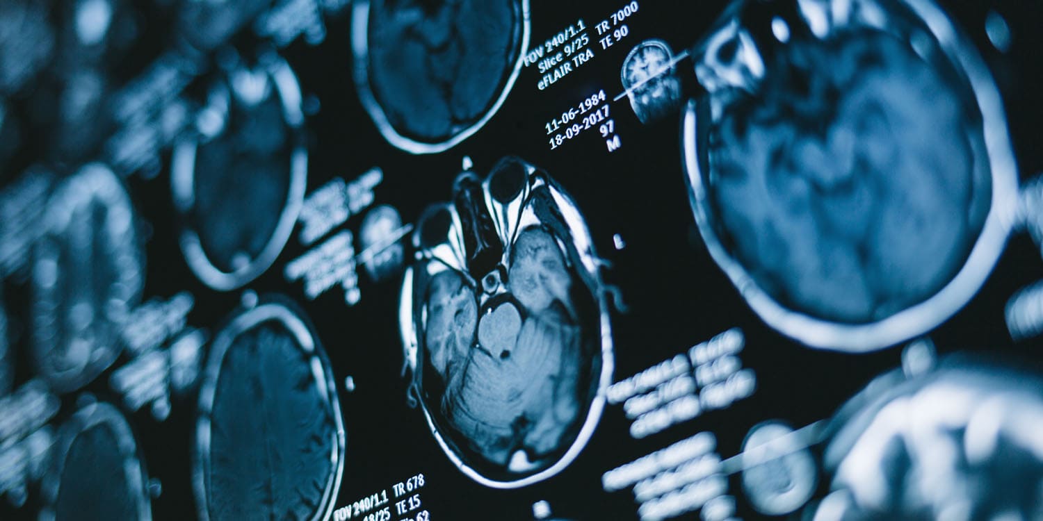 Alcohol use disorder patients show brain structure changes that may ...