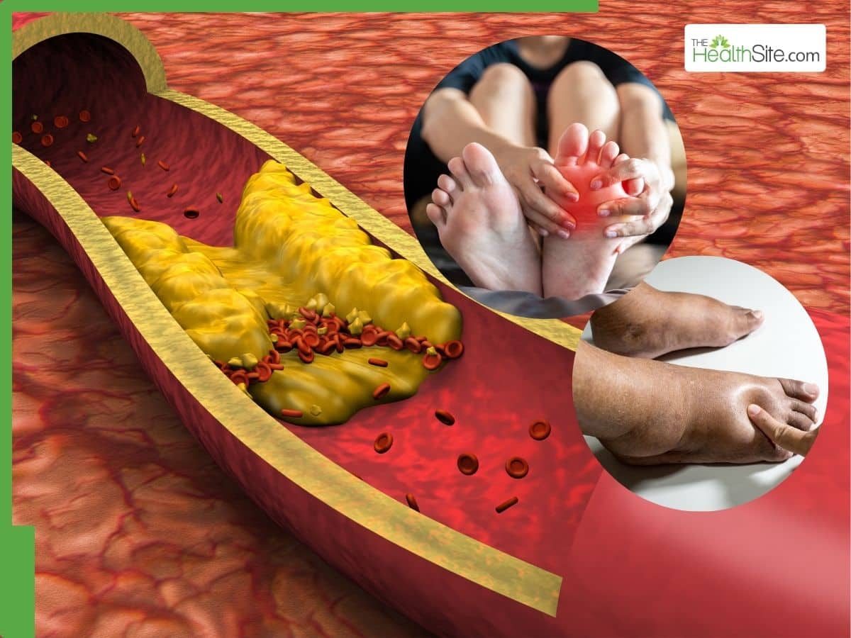 Clogged Arteries Symptoms: 7 Unusual Signs of Heart Blockage That ...