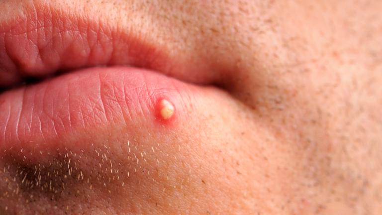 6 serious causes of white bumps on lips