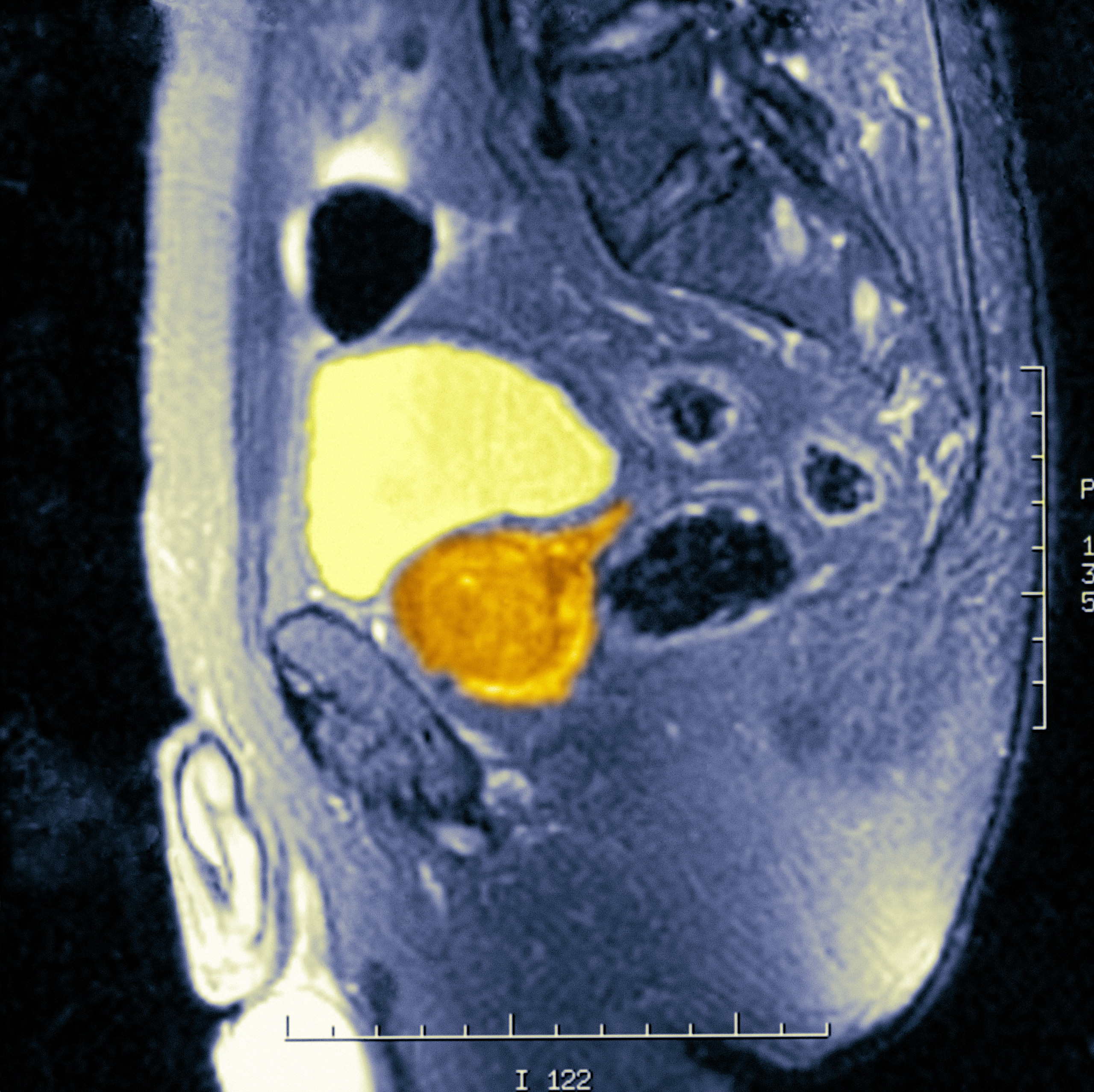 De risico's van een vergrote prostaat