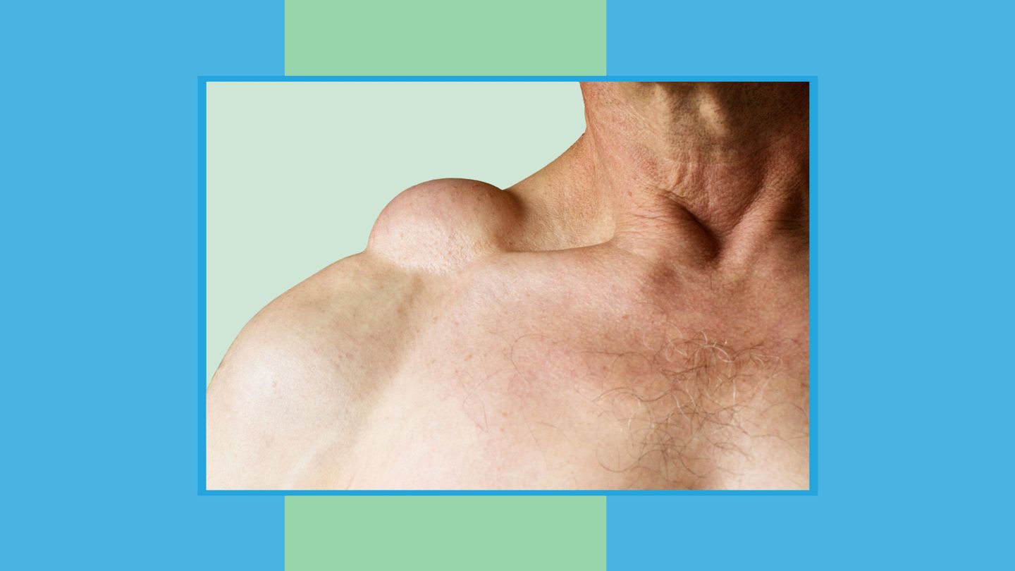 What’s Causing the Lump on My Shoulder?