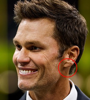 Plastic surgeons reveal why Tom Brady's face was 'gaunt' at Super Bowl