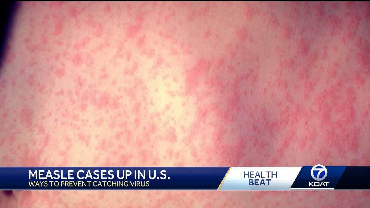 Measles spread to third county in New Mexico