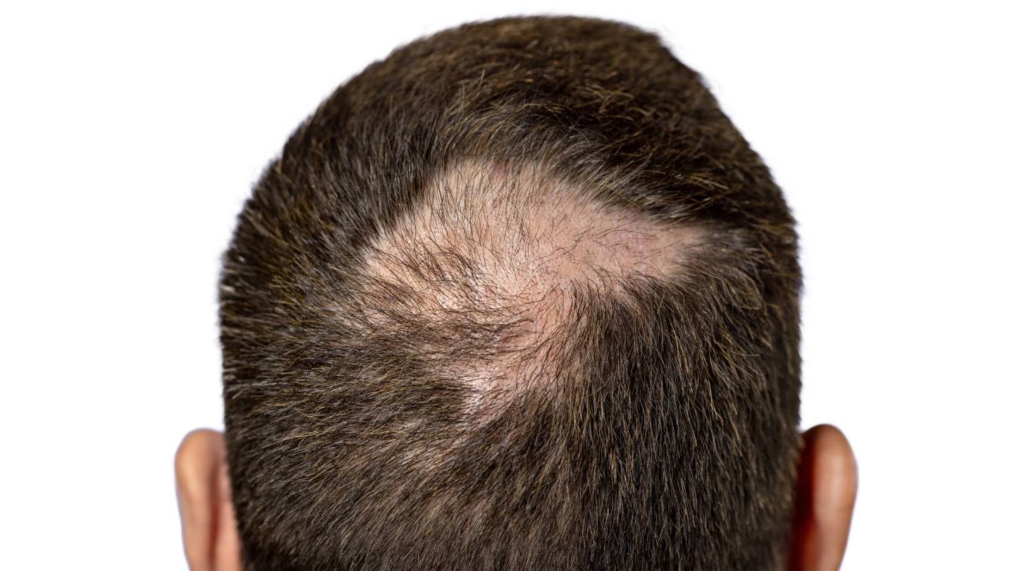 Q32 Bio halts trials amid job cuts and pivots to alopecia treatment