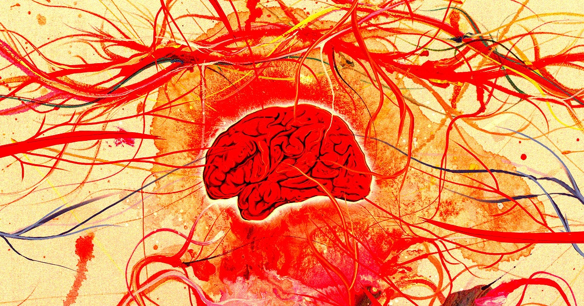 Microplastics Getting Stuck in Brain Vessels Like Clots, Scientists ...