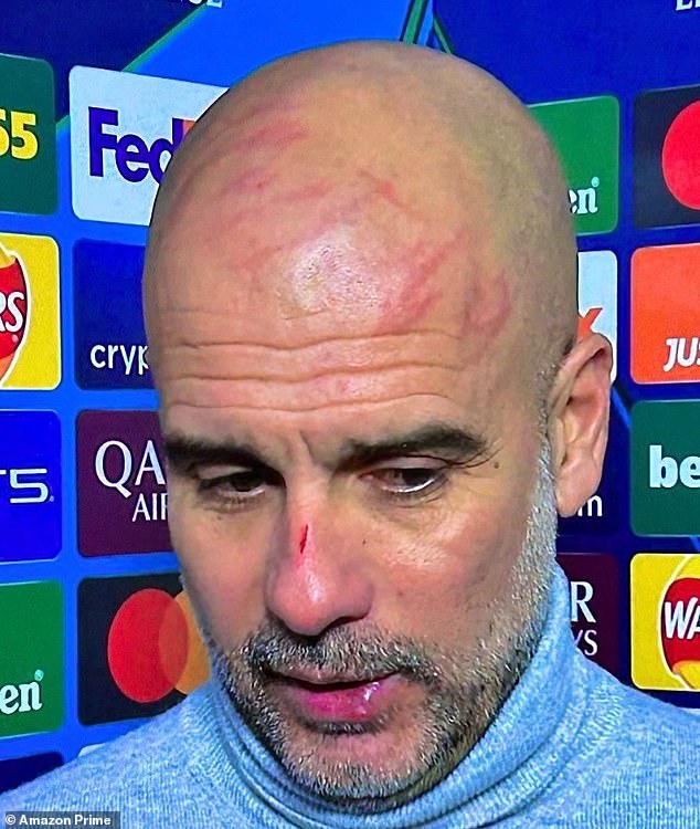 Pep Guardiola spotted with scratches on his head for the THIRD time ...