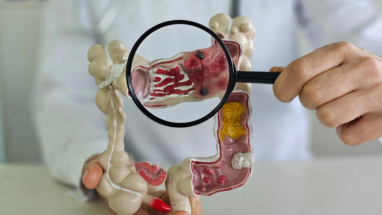 Bloating Is Common In People With Ulcerative Colitis: Expert Explains ...