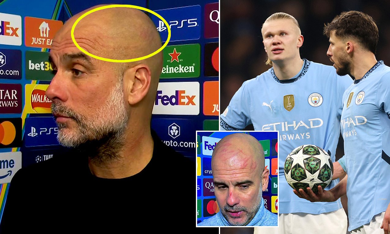 Pep Guardiola spotted with scratches on his head for the THIRD time ...