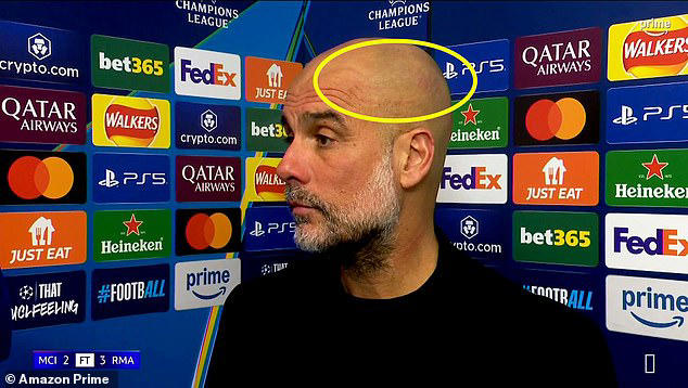 Pep Guardiola spotted with scratches on his head for the THIRD time ...