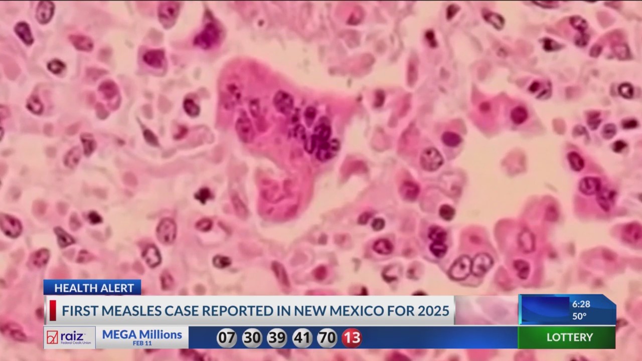 First measles case reported in NM for 2025