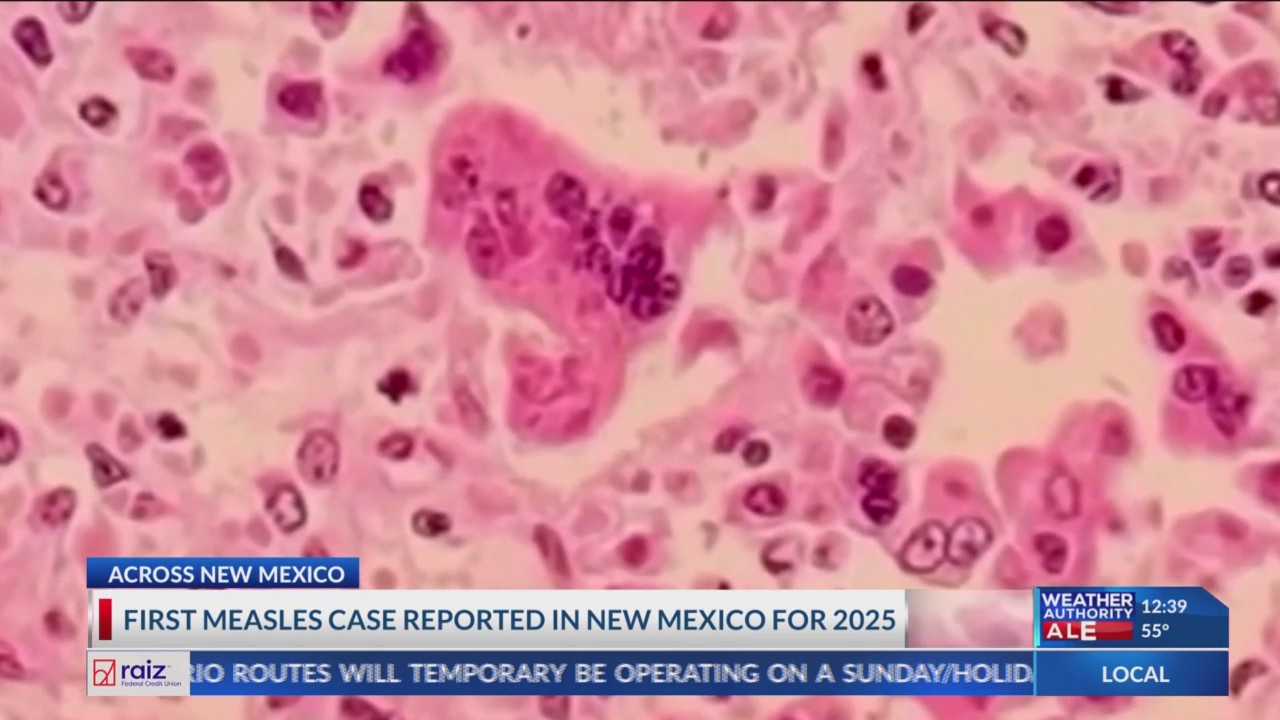 First measles case reported in New Mexico for 2025