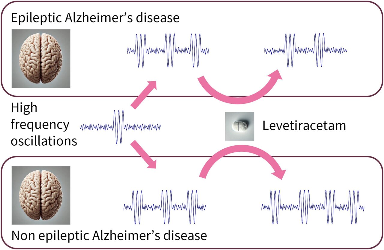 Brain rhythms can predict seizure risk in Alzheimer's disease patients ...