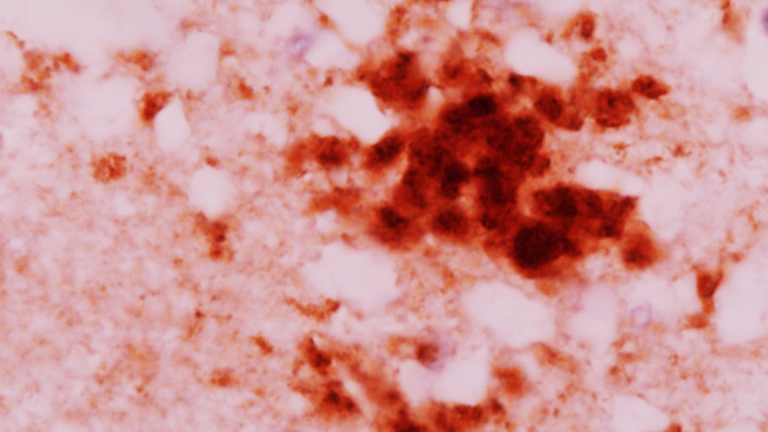 The exceptionally rare disease that causes holes to form in your brain