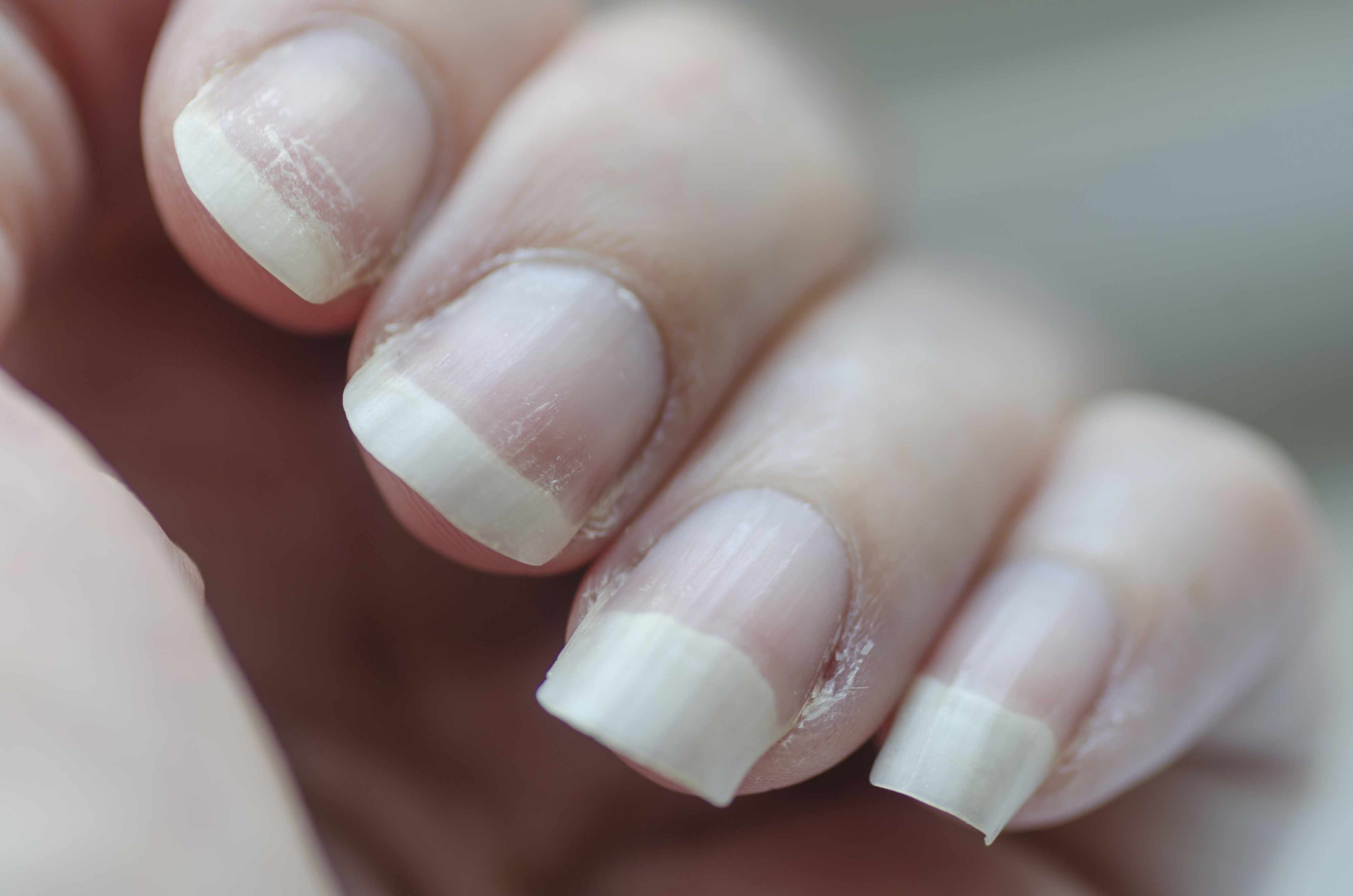 The best treatments for brittle nails