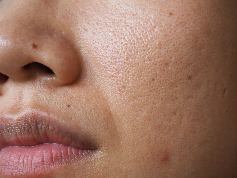 What Are Sebaceous Filaments and Why Are They on Your Face?
