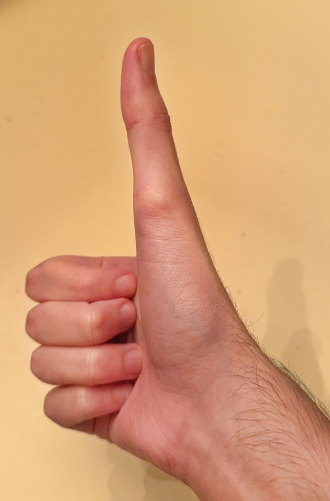 You Won’t Believe How Long This Guy’s Thumbs Are!