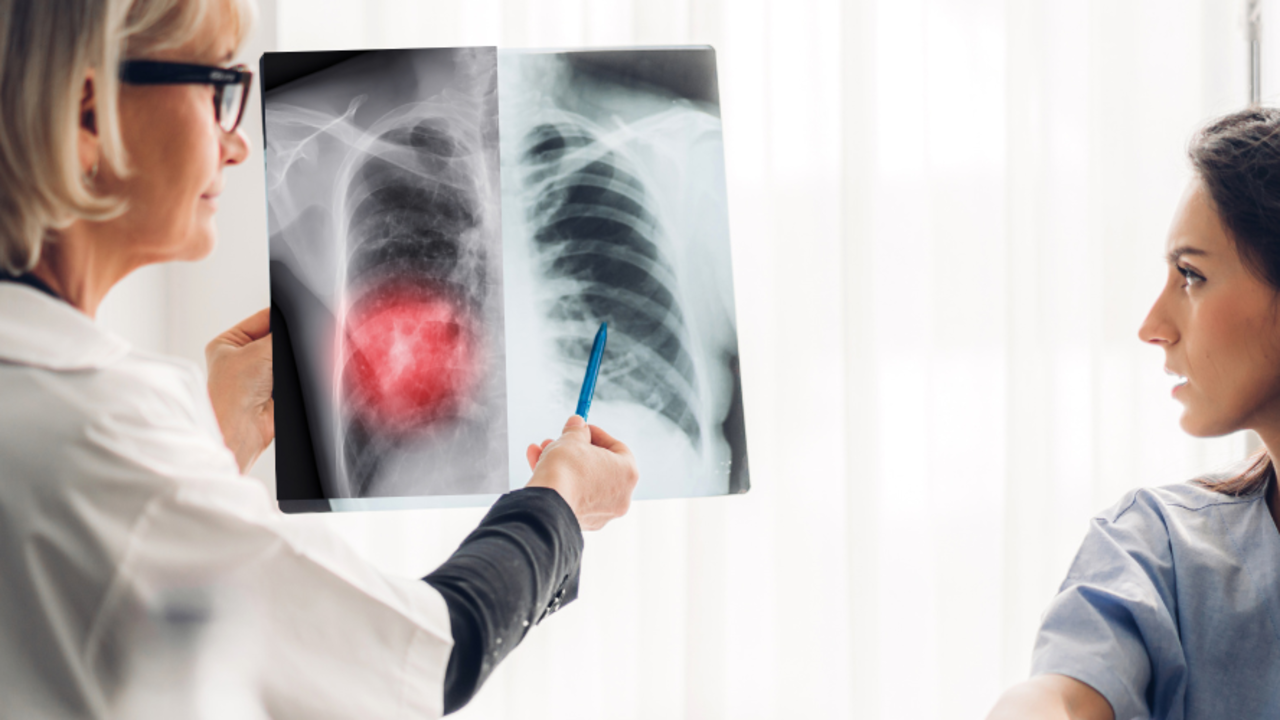 UK Faces ‘Serious’ TB Outbreak, Health Chief Issues Warning- Here Are ...