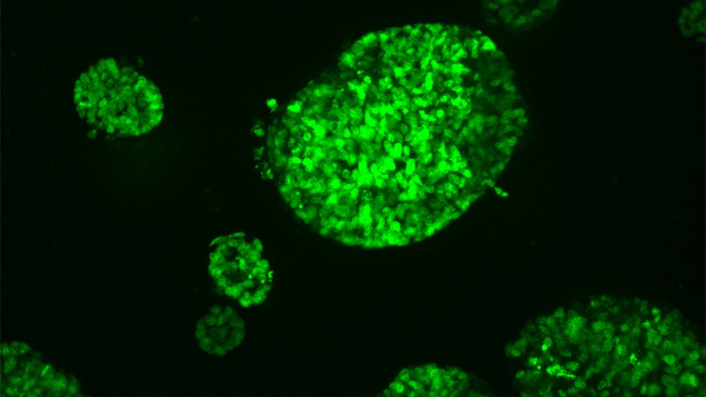 ICR scientists develop algorithm that predicts bowel cancer risk in IBD ...