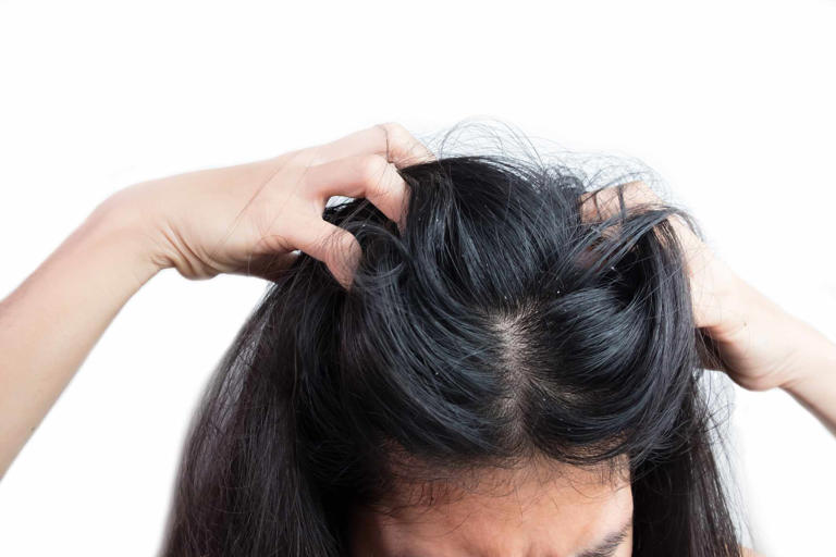 What is a scalp yeast infection?