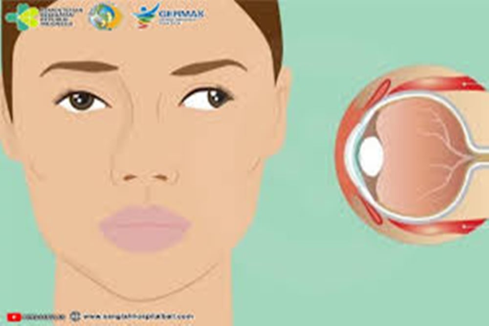 Jenis-Jenis Mata Juling, Gejala, Penyebab dan Cara Penanganannya