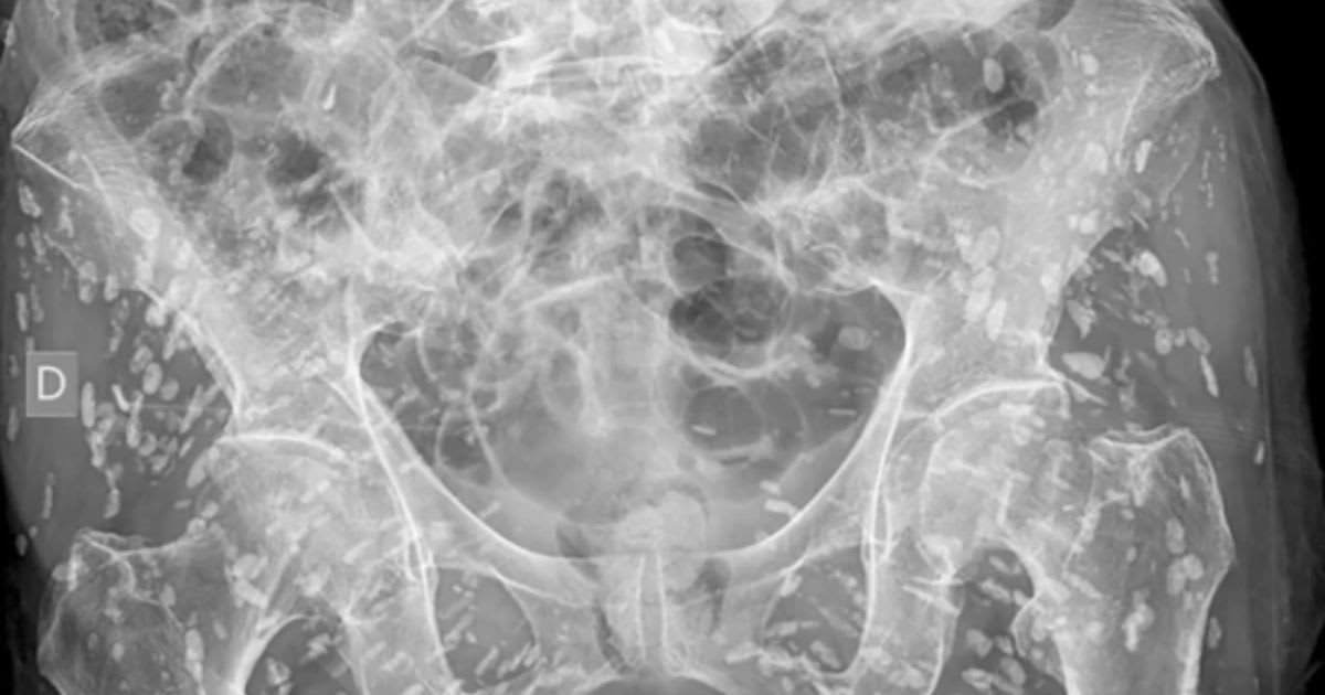 Nightmare Creatures: Doctor Astonished After Patient's X-Ray Shows Body ...