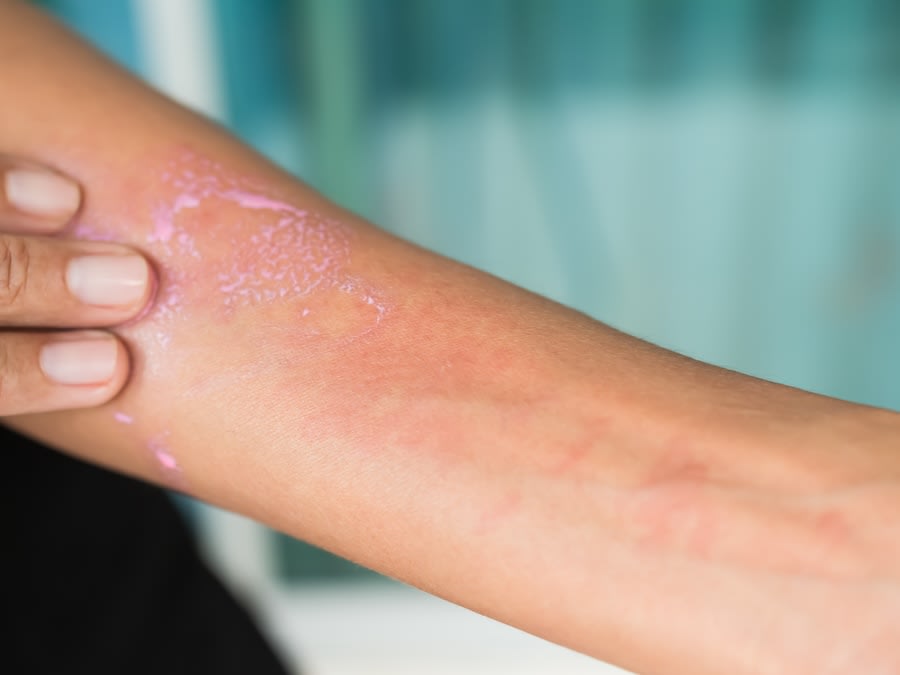What’s an at-home remedy for a burn?