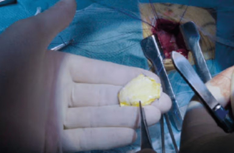 Researchers implant lab-grown heart patch in woman with advanced heart ...