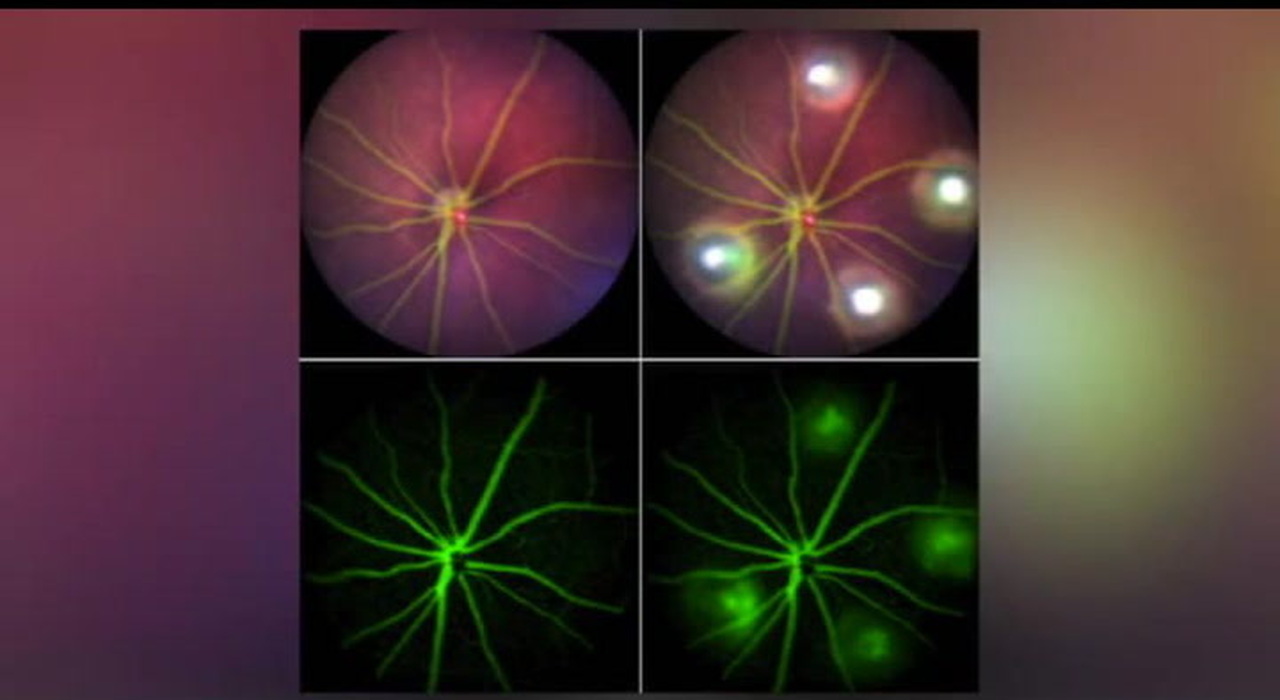Malattie oculari, in arrivo "pillola" che sostituisce l'iniezione