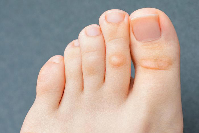 7 Home Remedies to Remove Corns and Calluses on Feet Overnight
