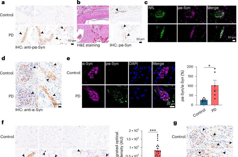 The link between renal failure and Parkinson's disease: Researchers ...