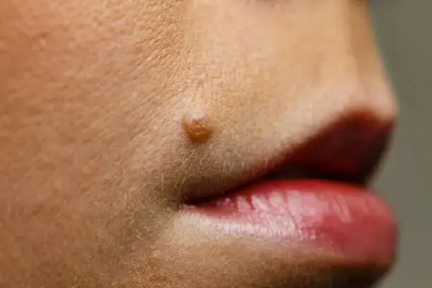 World Cancer Day 2025: Can too much exposure to sun lead to lip cancer ...