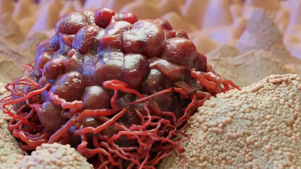 World Cancer Day: 5 Deadliest Types Of Cancer