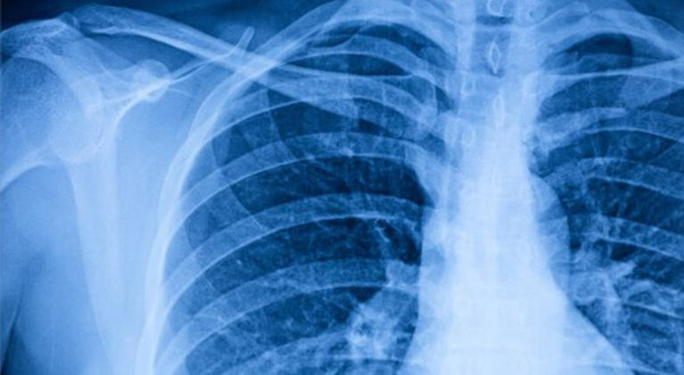 Crescono le polmoniti da influenza, ospedali e medici di famiglia in affanno: «Troppi casi nei ...