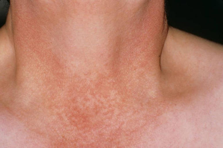 Urgent cancer warning issued by doctor over hot water bottle mistake