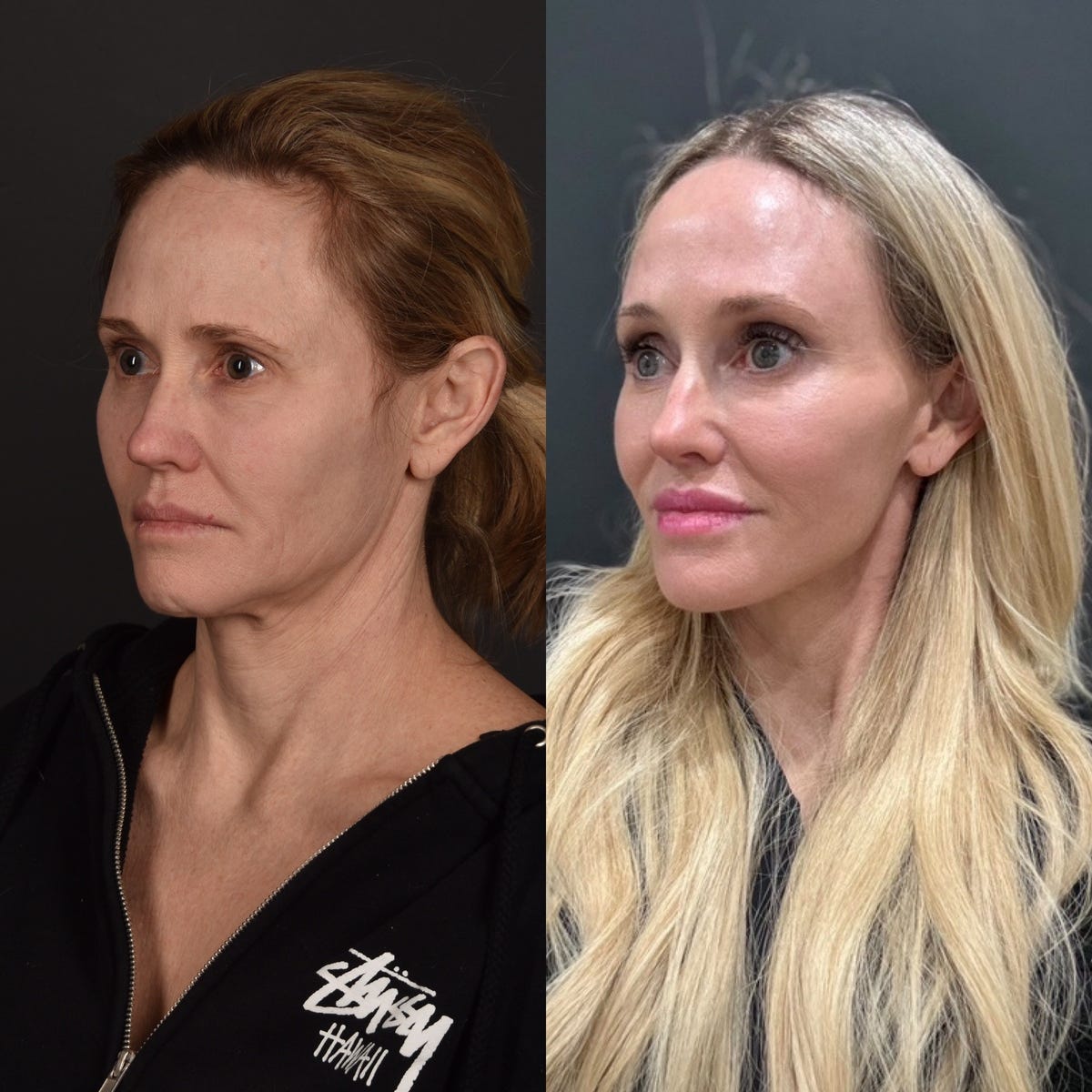 ‘Why Wait?’: 9 Women on Getting a Facelift in Their 40s