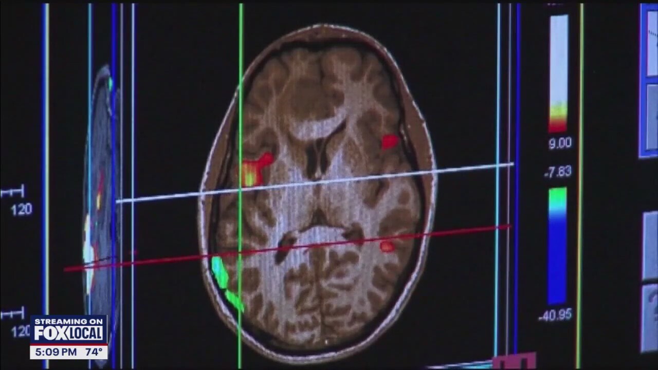 Study finds microplastics accumulating in human brains